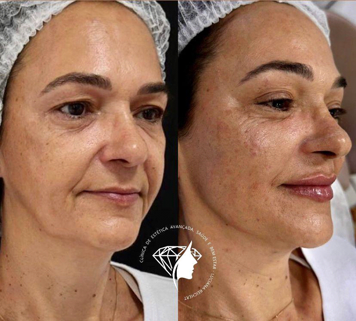 Bioestimulador de Colágeno - Luciana Reichert Estetica